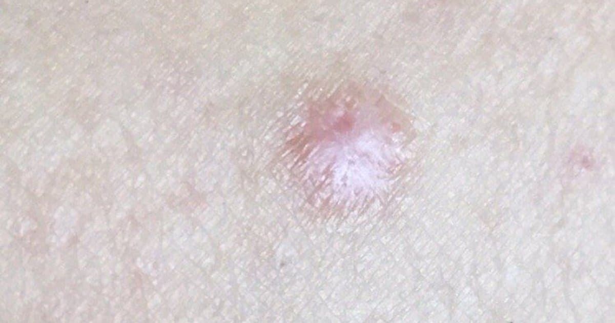 Dermatofibroma: Causes, Dimple Sign, Diagnosis & Removal Options ...