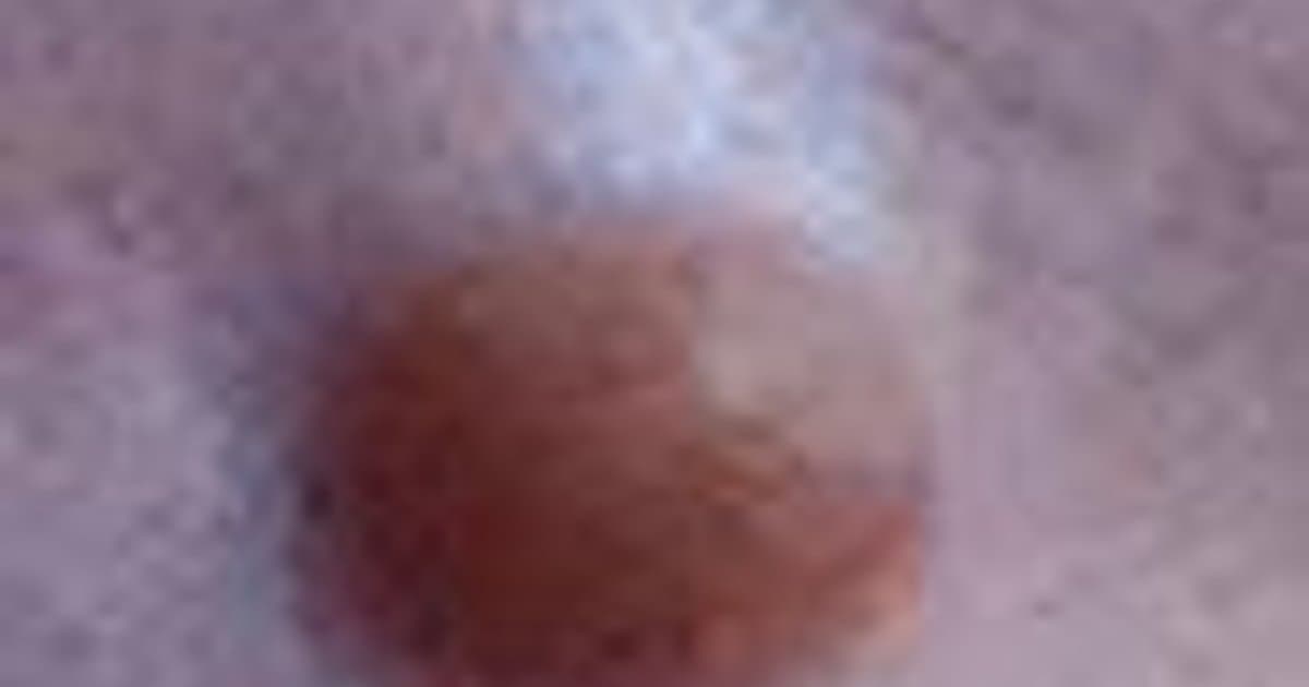 Spitz Nevus: Diagnosis, Melanoma Mimicry & Management in Children and ...