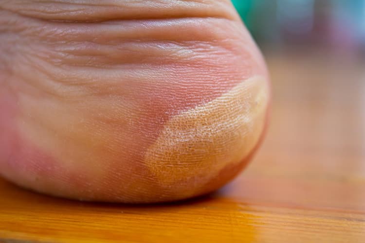 Tinea Pedis (Pé de Atleta) | Tipos, Causas e Tratamento