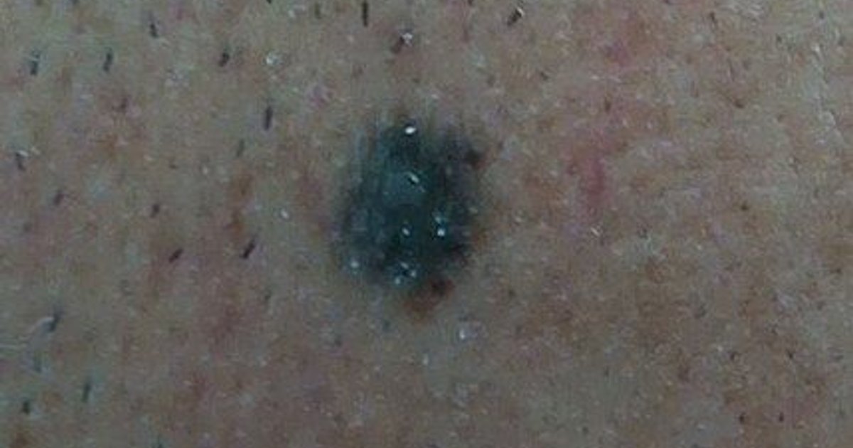Blue Nevus: Causes, Types, Tyndall Effect & Melanoma Risk | Skinscanner