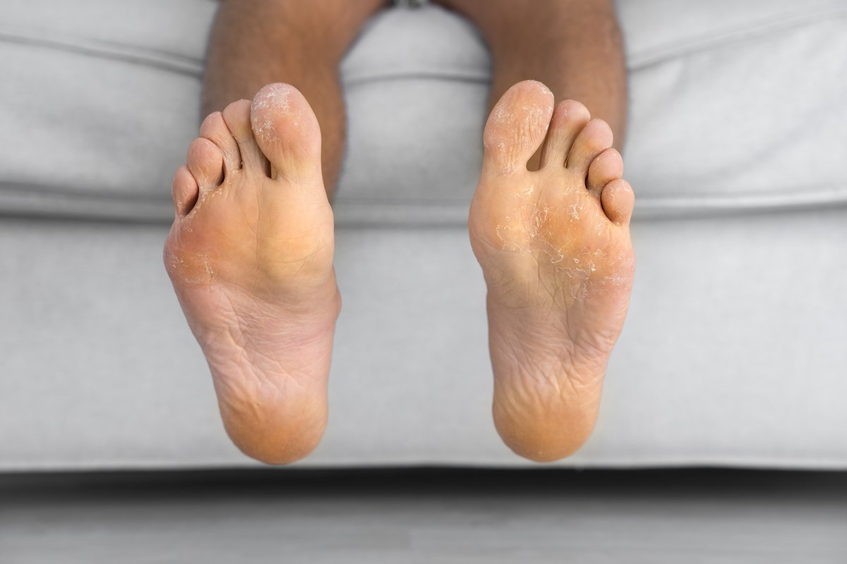 Tinea Pedis (Pie de atleta) | Tipos, Causas y Tratamiento